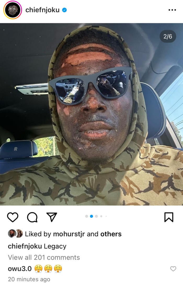 Browns’ David Njoku shares picture of burned face following fire accident